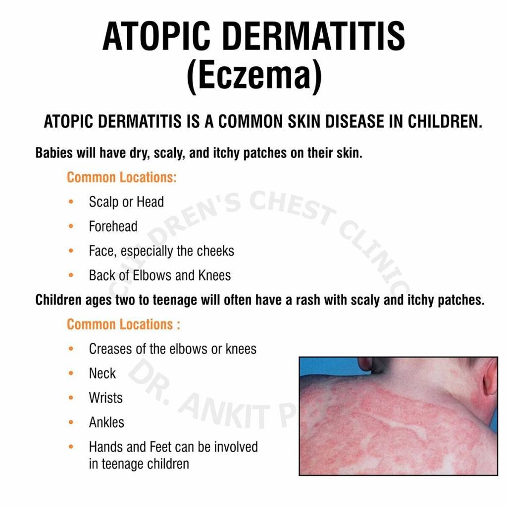 Atopic Dermatitis Eczema - Dr. Ankit Parakh – India's best Pediatric ...