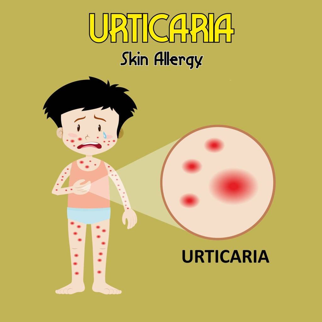 Itchy bumps on skin: Urticaria or hives in children - Dr. Ankit Parakh ...