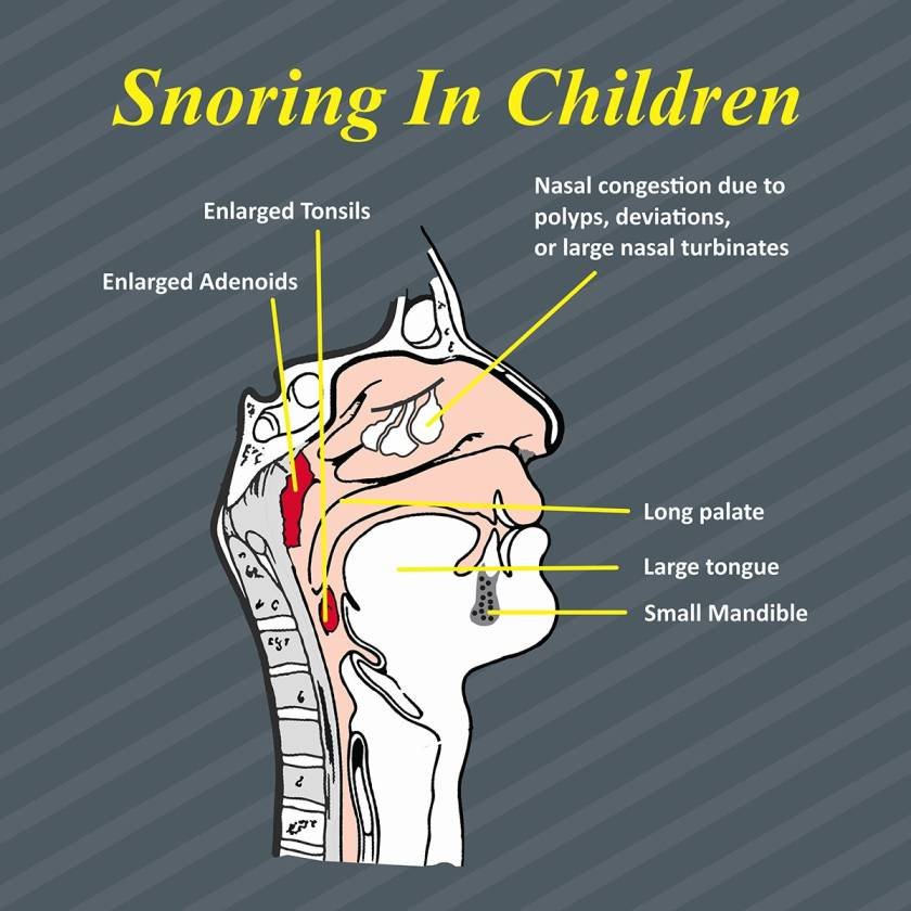 Snoring in children: When to worry? - Dr. Ankit Parakh – India's best ...