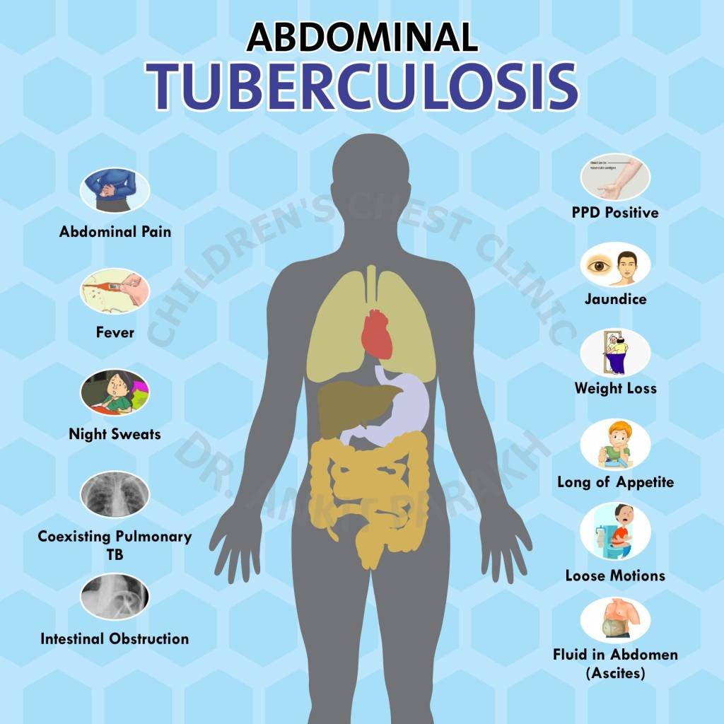 Abdominal Tuberculosis in Children - Dr. Ankit Parakh – India's best ...