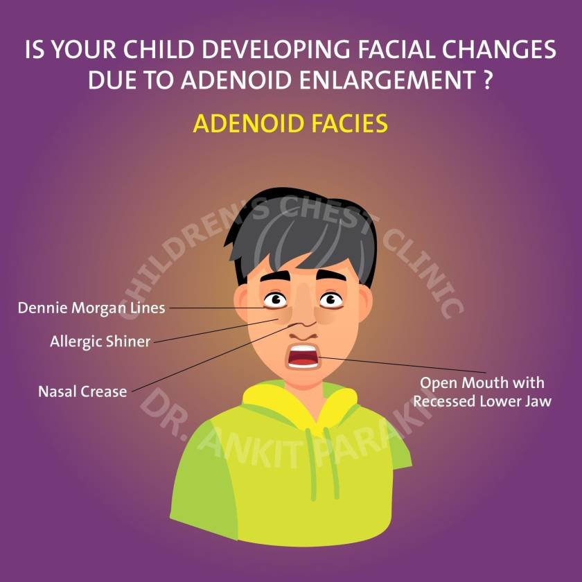 Is your child developing facial changes due to an enlarged adenoid ...