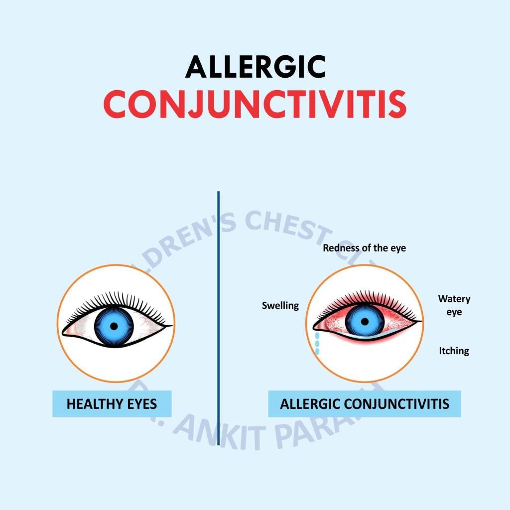 Allergic Conjunctivitis – Dr. Ankit Parakh – India's best Pediatric ...