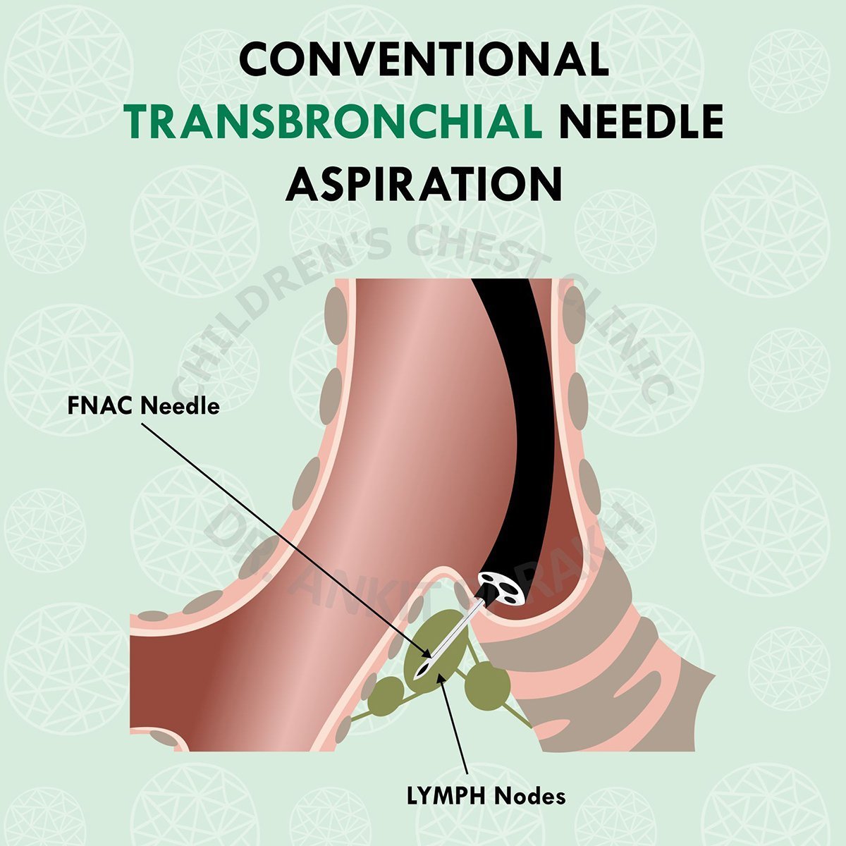 Pediatric Interventional Bronchoscopy – Dr. Ankit Parakh – India's best ...