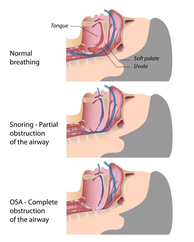 Obstructive Sleep Apnea – Dr. Ankit Parakh – India's best Pediatric ...